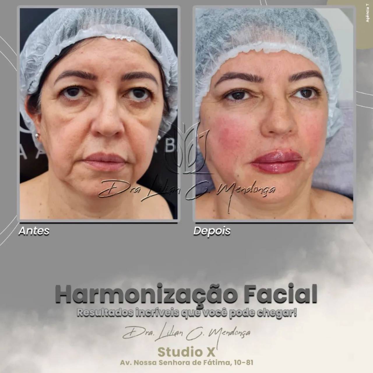 Harmonização facial em bauru em Bauru, SP | Classificados - Solutudo Harmonização facial em bauru em Bauru, SP | Classificados - Solutudo
